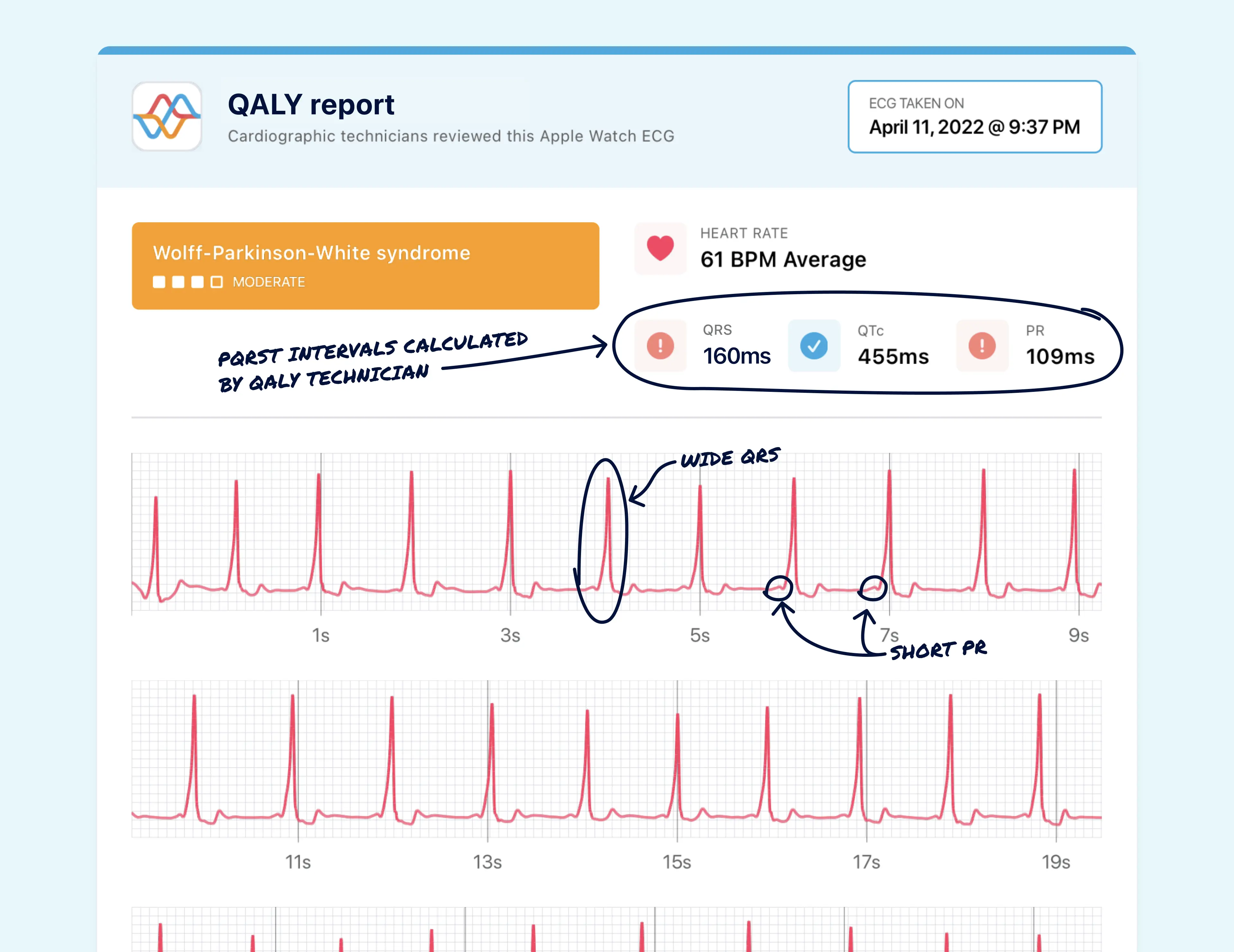 QRS Interval on Your Watch ECG - Narrow, Normal, and Wide | Qaly